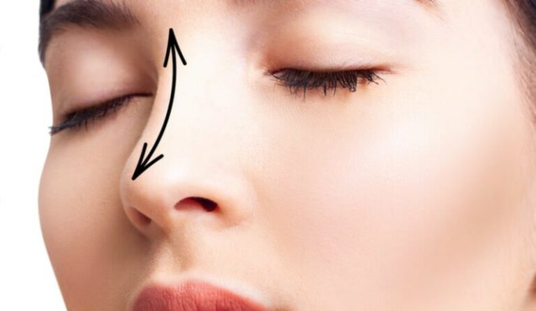 Fils Tenseurs PDO (rhinoplastie) | Clinique Corps Idéal